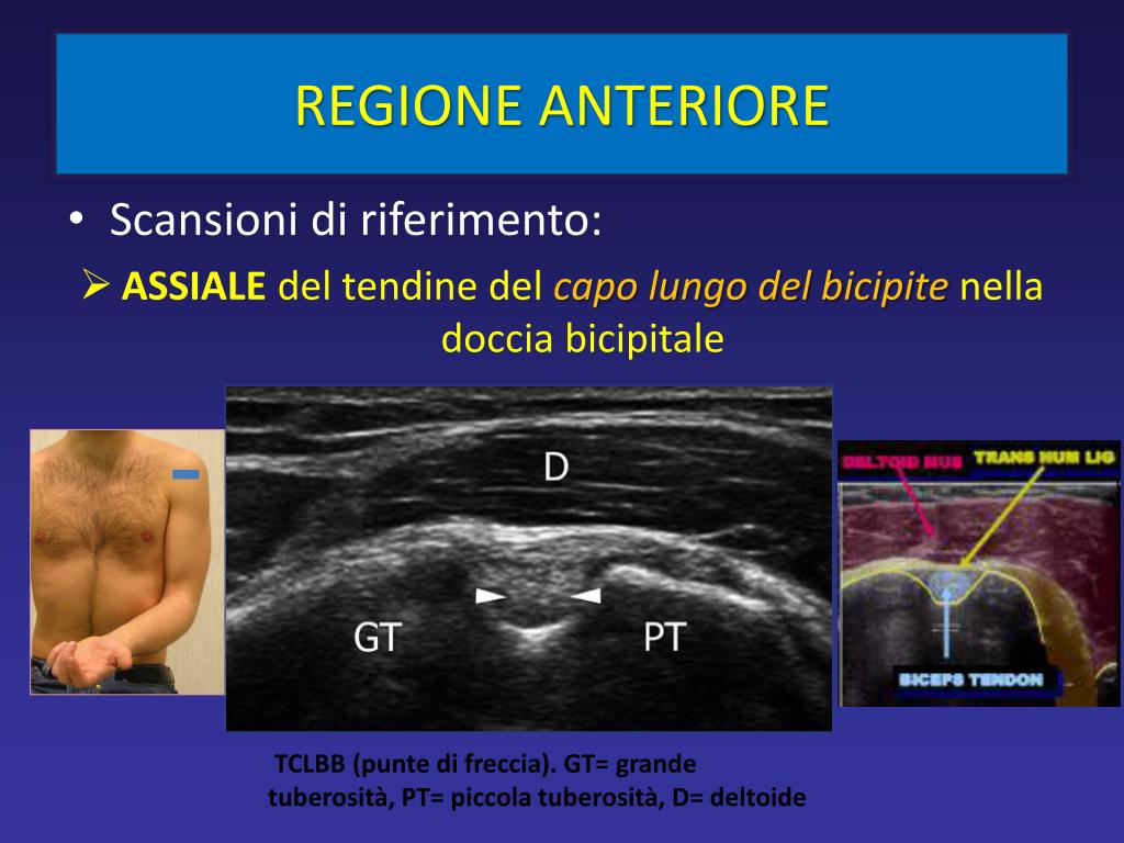 PPT - ANATOMIA PER IMMAGINI DELLA SPALLA: ECOGRAFIA PowerPoint ...