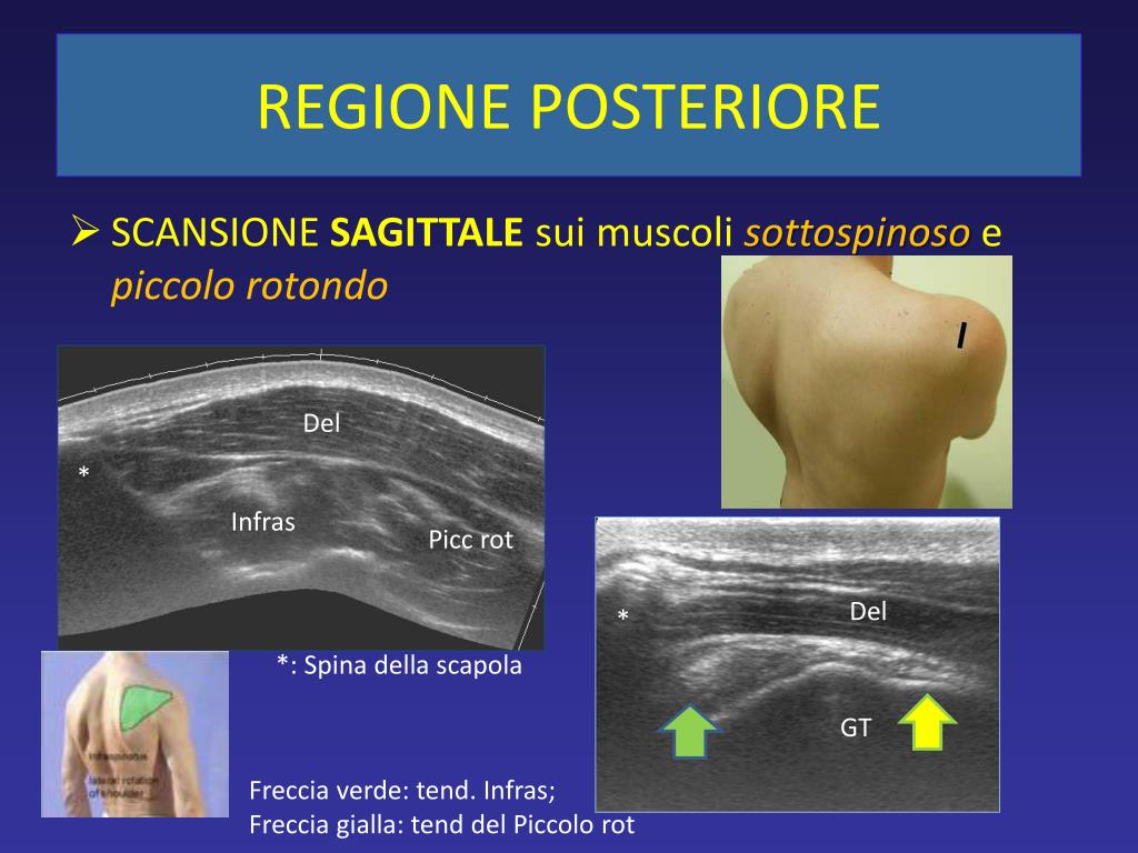 PPT - ANATOMIA PER IMMAGINI DELLA SPALLA: ECOGRAFIA PowerPoint ...