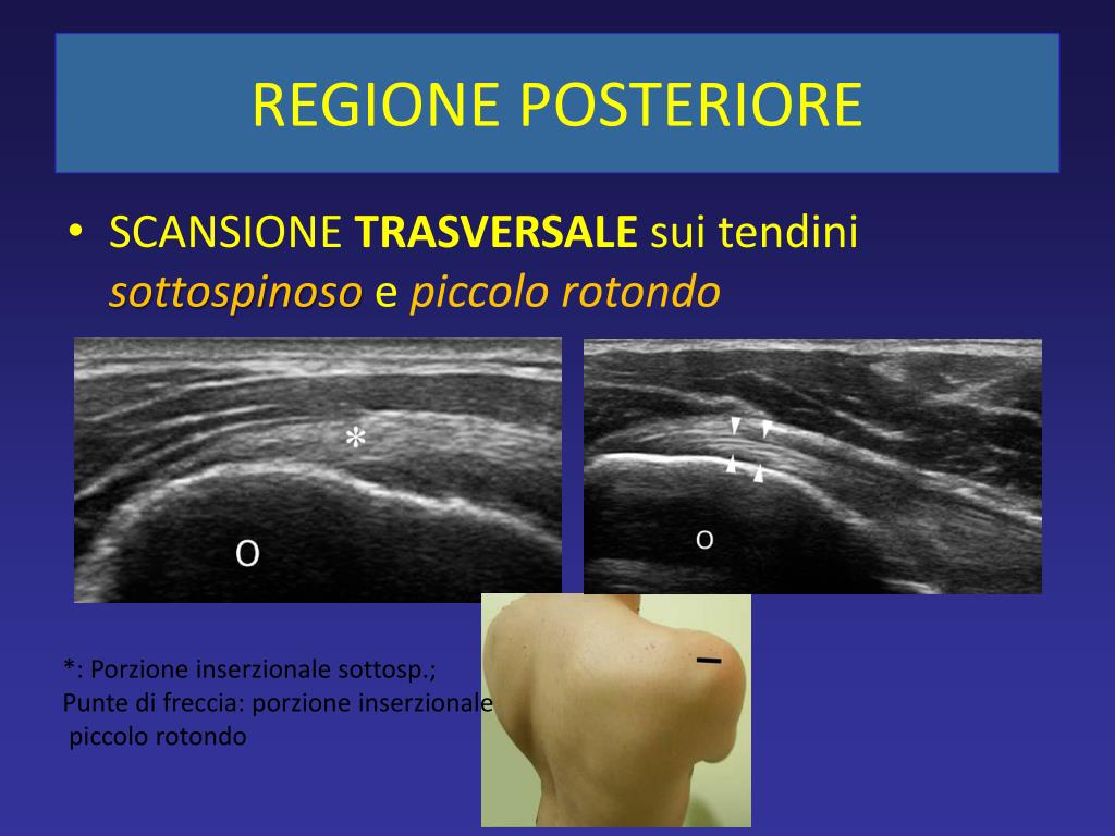 PPT - ANATOMIA PER IMMAGINI DELLA SPALLA: ECOGRAFIA PowerPoint ...