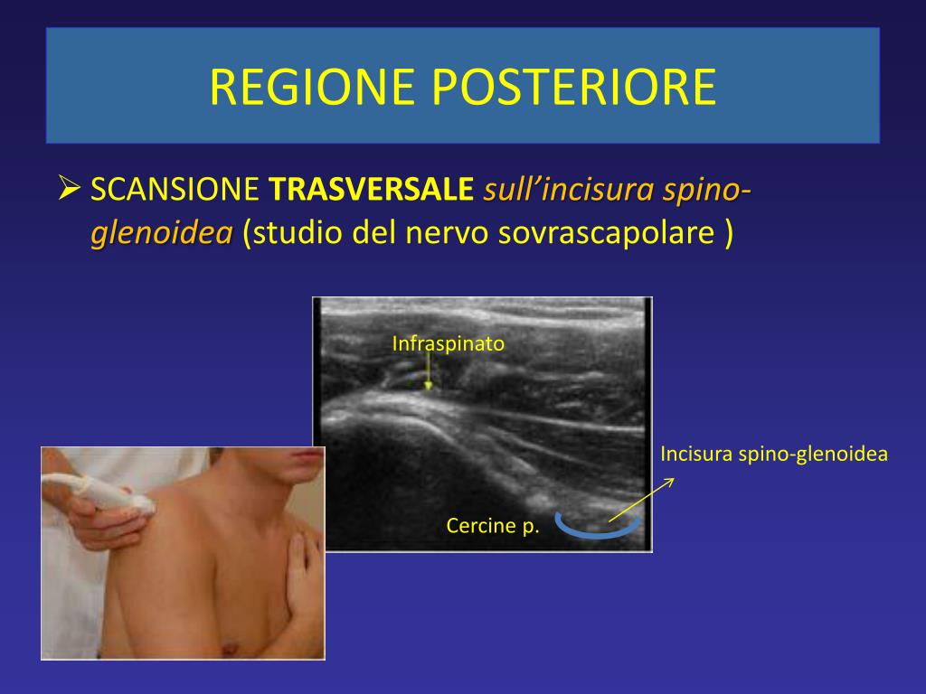 PPT - ANATOMIA PER IMMAGINI DELLA SPALLA: ECOGRAFIA PowerPoint ...