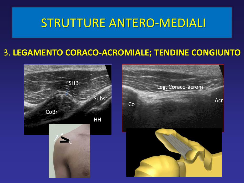 PPT - ANATOMIA PER IMMAGINI DELLA SPALLA: ECOGRAFIA PowerPoint ...