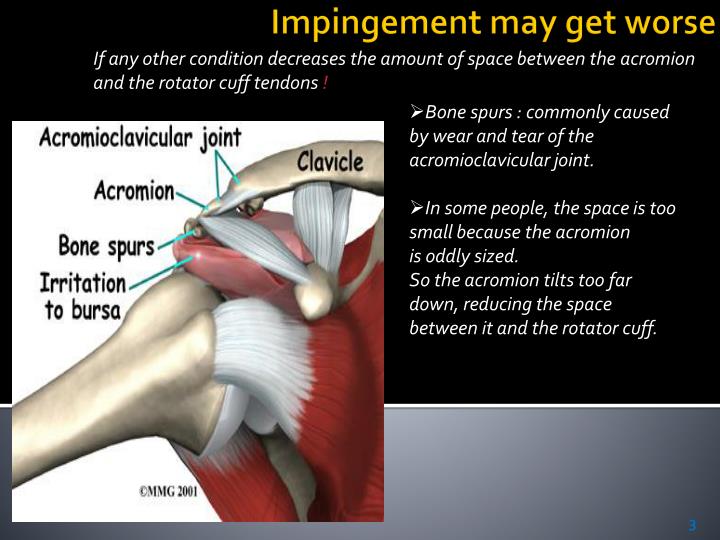 PPT - Shoulder Impingement Syndrome PowerPoint Presentation - ID:2381718