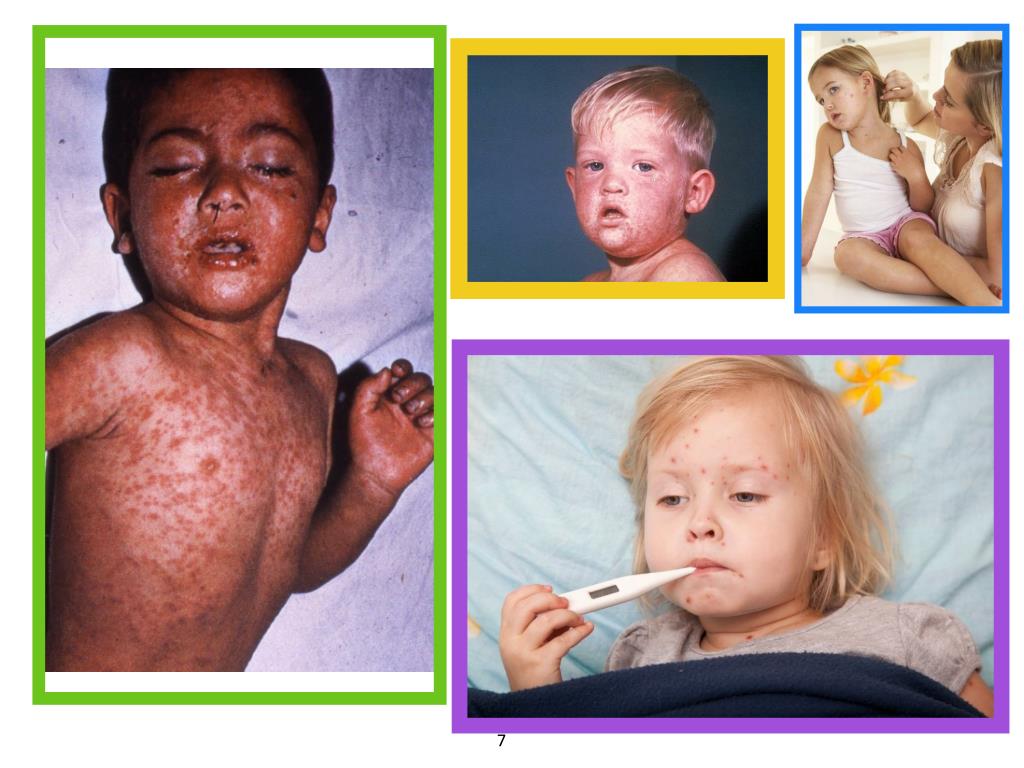 PPT - Sarampión PowerPoint Presentation, free download - ID:2382449