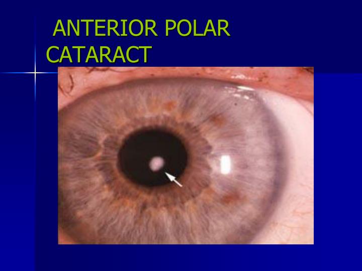 PPT - LEUKOCORIA PowerPoint Presentation - ID:2390163