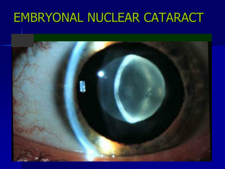 PPT - LEUKOCORIA PowerPoint Presentation - ID:2390163