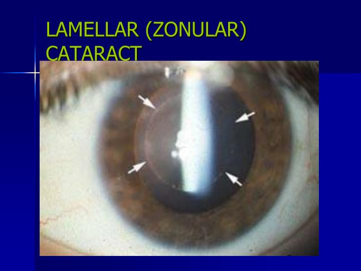 PPT - LEUKOCORIA PowerPoint Presentation - ID:2390163