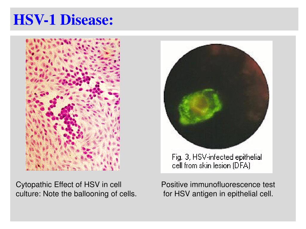 PPT - Viral Infections of the Respiratory Tract PowerPoint Presentation ...