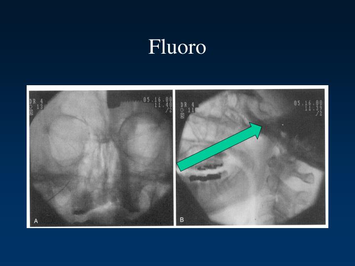 PPT - Trigeminal ( Gasserian ) Ganglion Block PowerPoint Presentation ...