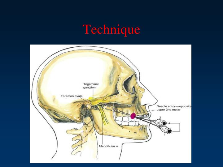 PPT - Trigeminal ( Gasserian ) Ganglion Block PowerPoint Presentation ...