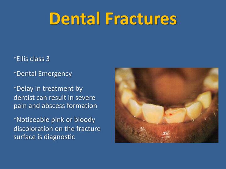 PPT - Facial Trauma PowerPoint Presentation - ID:2392727