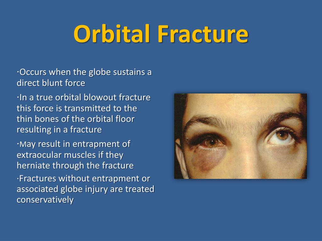Orbital Floor Fracture Causes Symptoms Diagnosis Trea - vrogue.co Orbital Floor Fracture Causes Symptoms Diagnosis Trea - vrogue.co