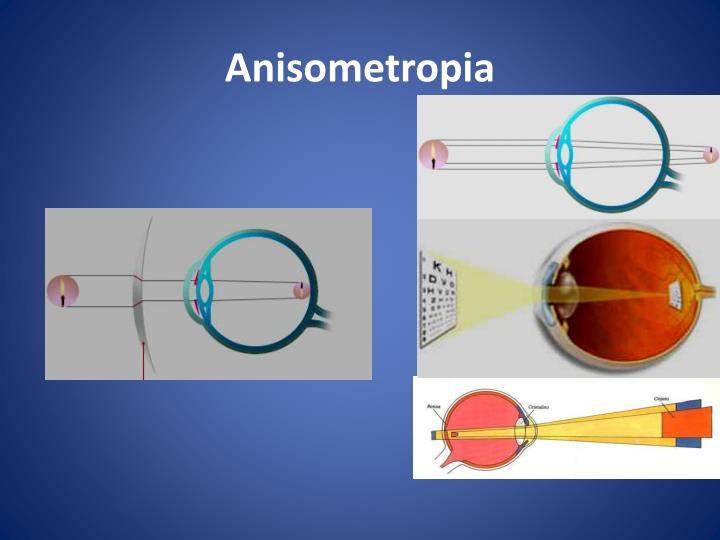 PPT - FISIOPATOLOGIA DE TRASTORNOS OCULARES FRECUENTES PowerPoint ...