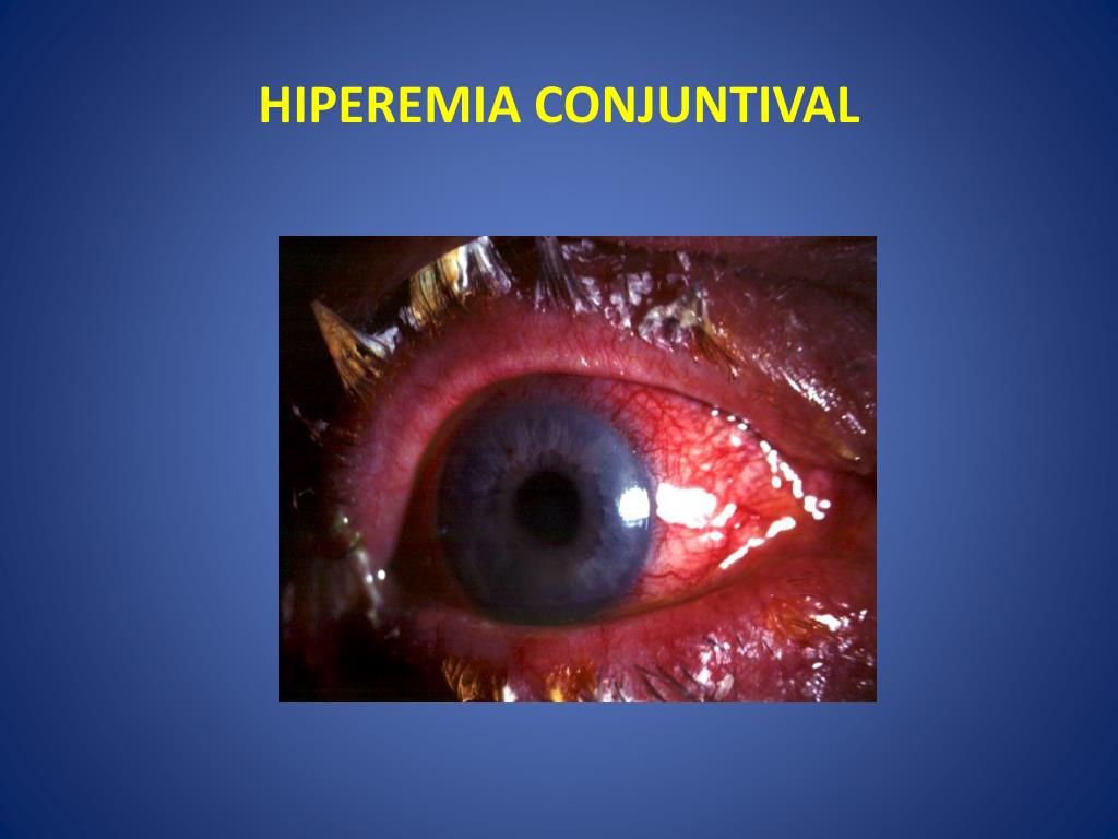 PPT - FISIOPATOLOGIA DE TRASTORNOS OCULARES FRECUENTES PowerPoint ...