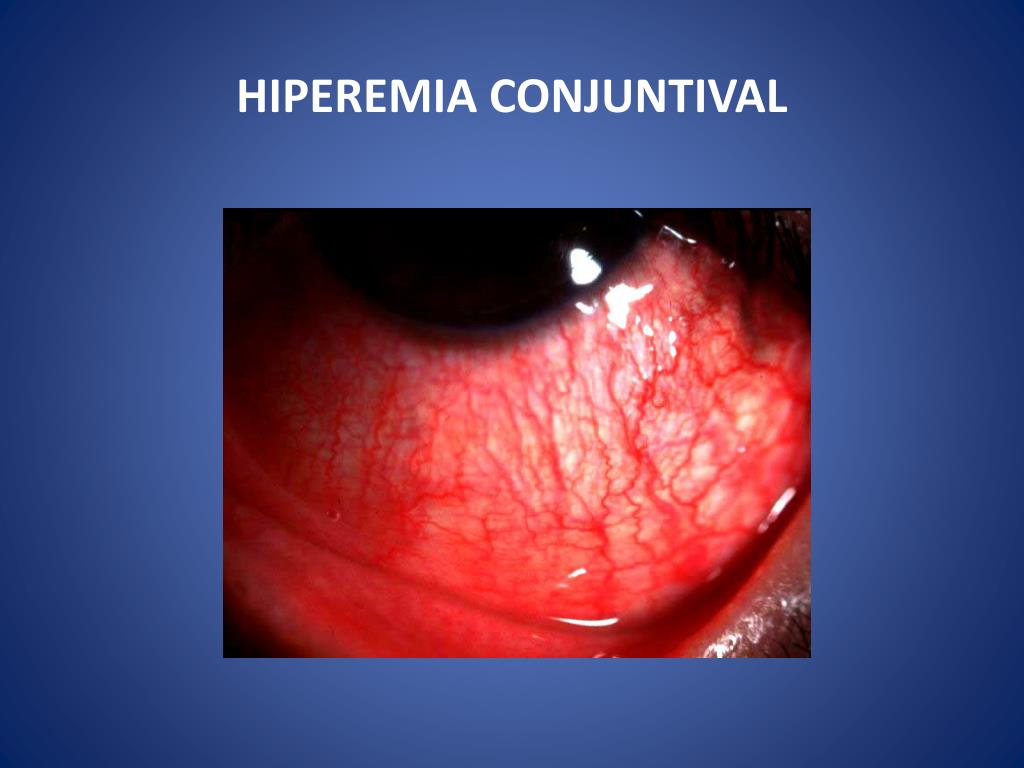 PPT - FISIOPATOLOGIA DE TRASTORNOS OCULARES FRECUENTES PowerPoint ...