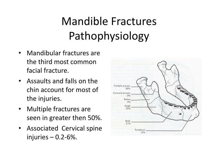 PPT - FRACTURES OF MAXILLA AND MANDIBLE PowerPoint Presentation - ID ...