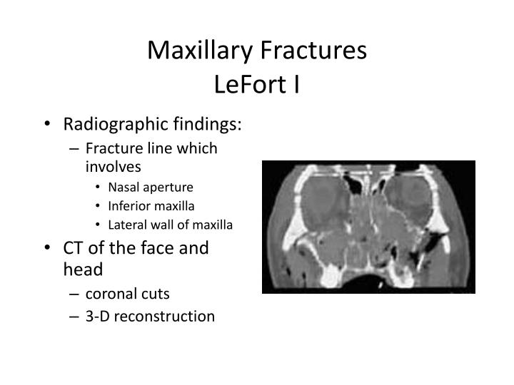 PPT - FRACTURES OF MAXILLA AND MANDIBLE PowerPoint Presentation - ID ...