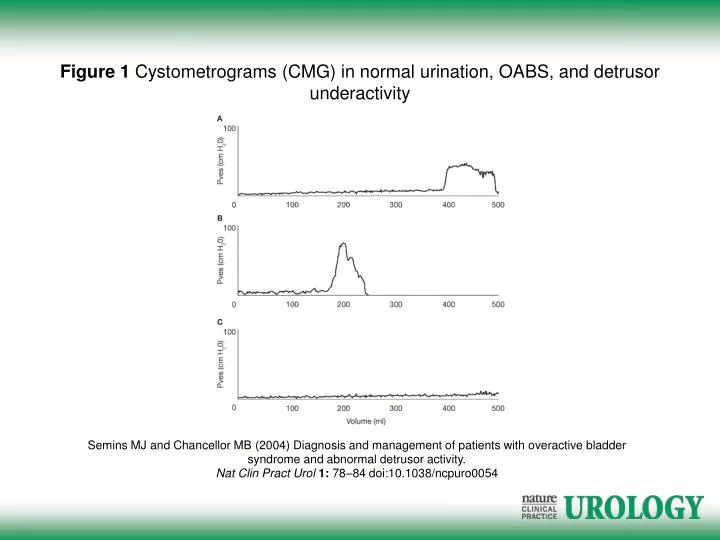 PPT - Figure 1 Cystometrograms (CMG) in normal urination, OABS, and ...