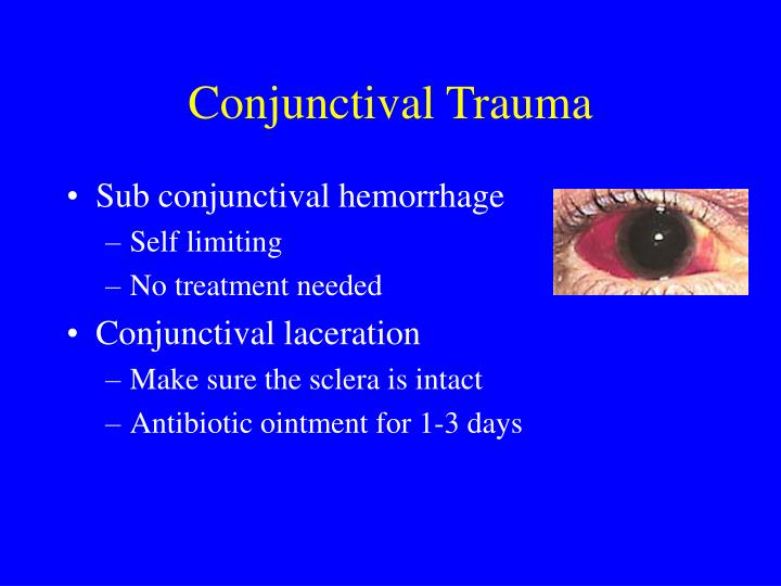 PPT - Ocular Trauma PowerPoint Presentation - ID:2399670
