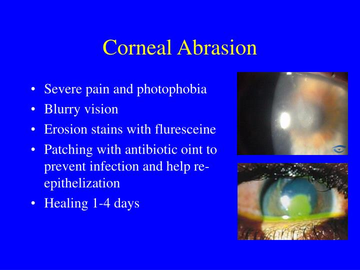 PPT - Ocular Trauma PowerPoint Presentation - ID:2399670