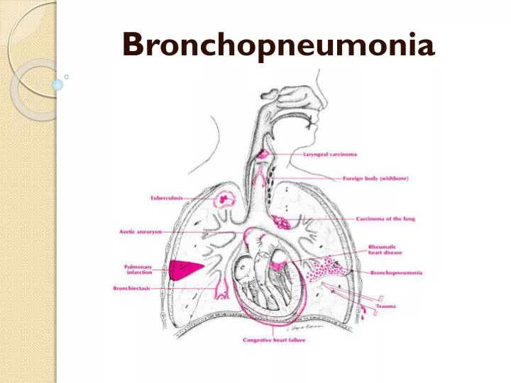 PPT - Bronchopneumonia PowerPoint Presentation - ID:2399792