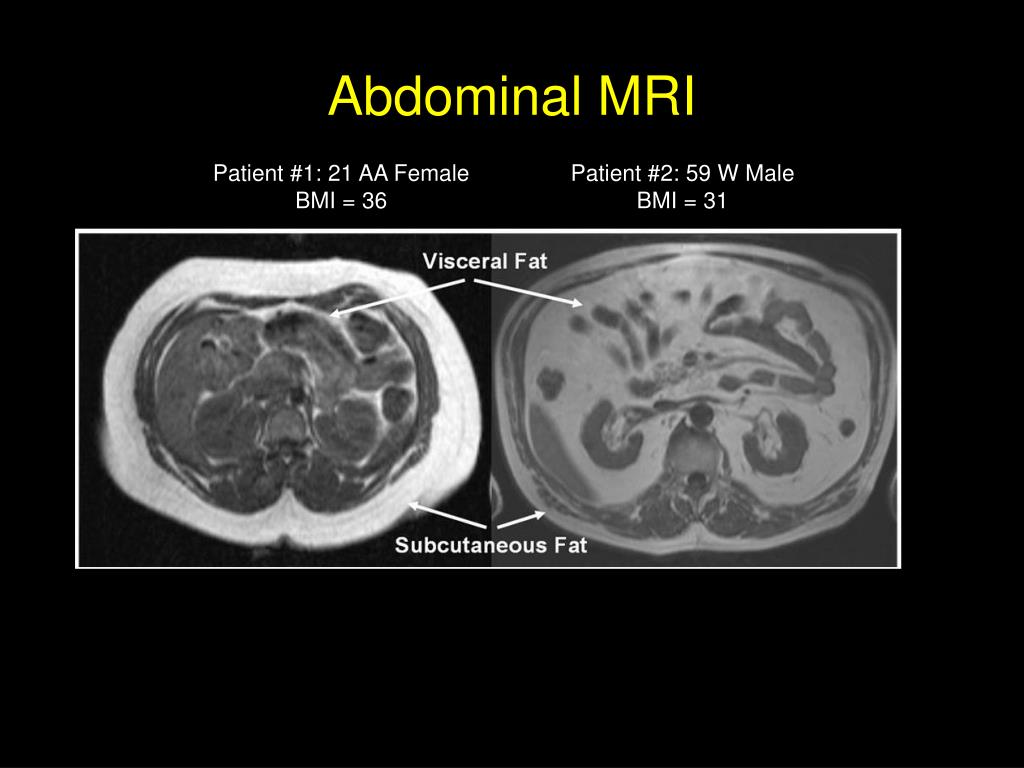 PPT - Dysfunctional Adiposity and the Risk of Prediabetes and Type 2 ...