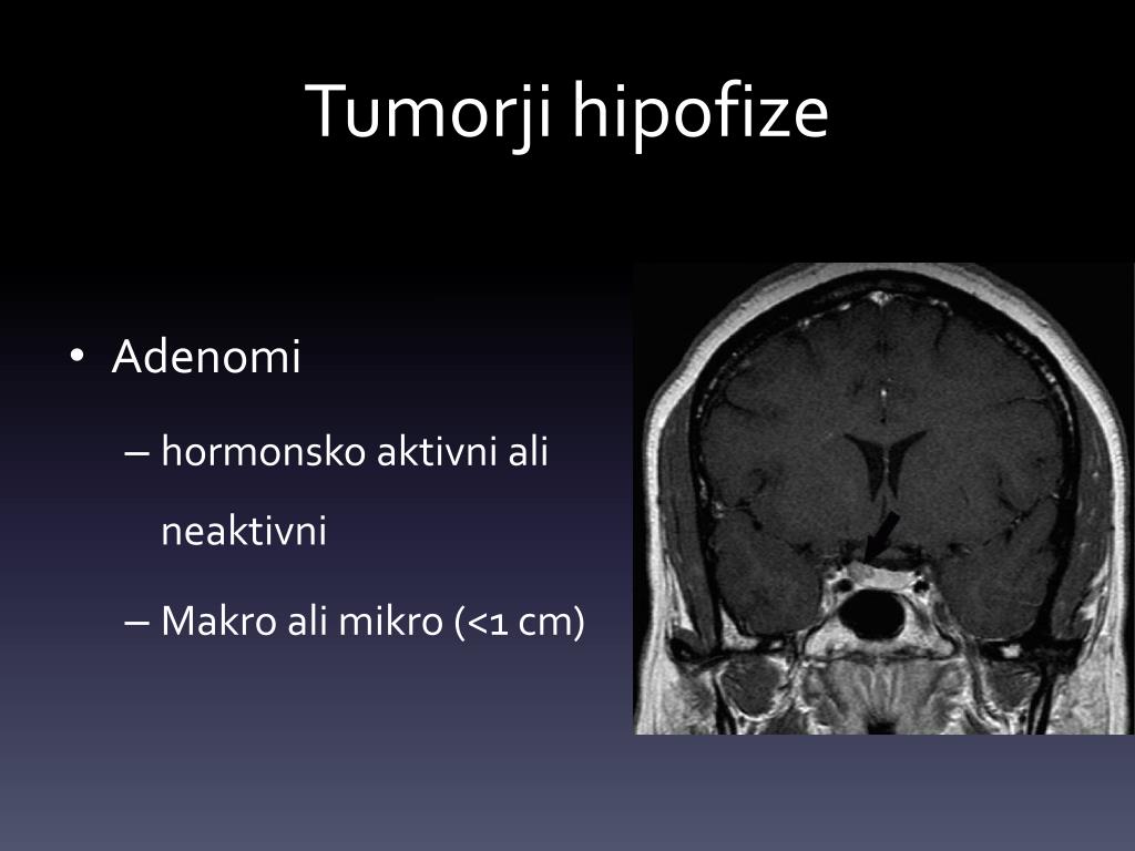 PPT - Nevroradiologija tumorjev živčevja PowerPoint Presentation, free ...