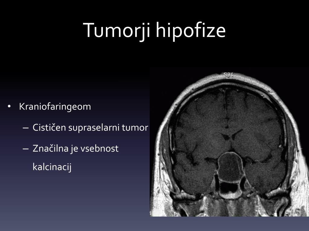 PPT - Nevroradiologija tumorjev živčevja PowerPoint Presentation, free ...