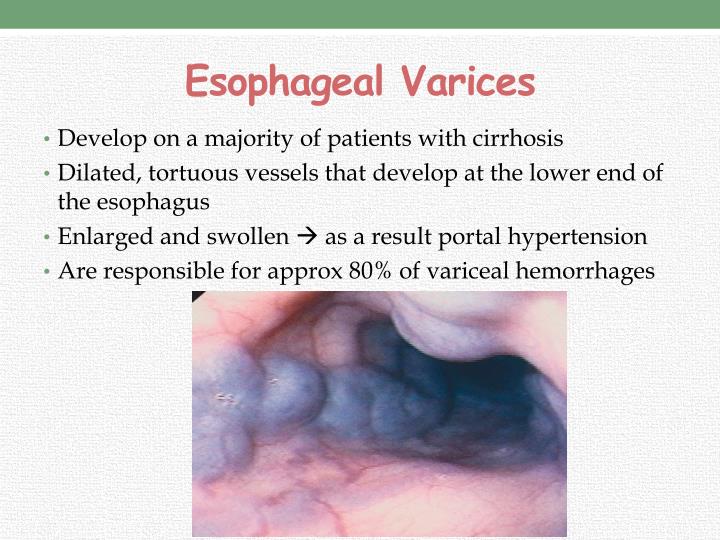 Esophageal Varices