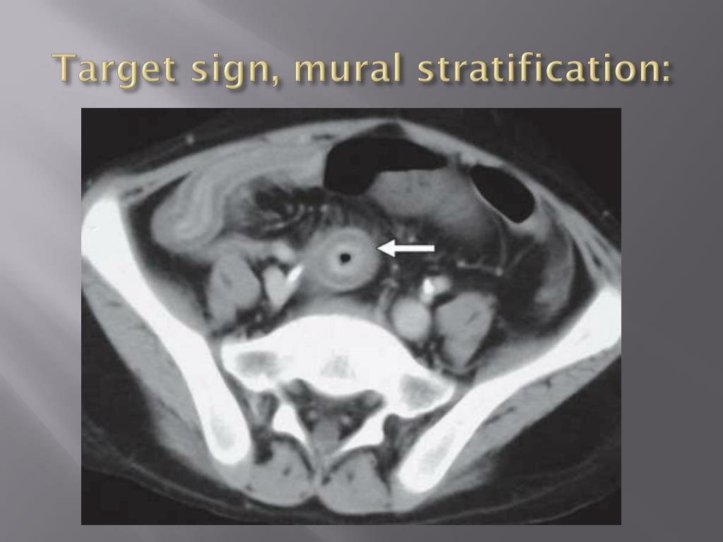PPT - Bowel Wall Thickening in Children: CT Findings PowerPoint ...