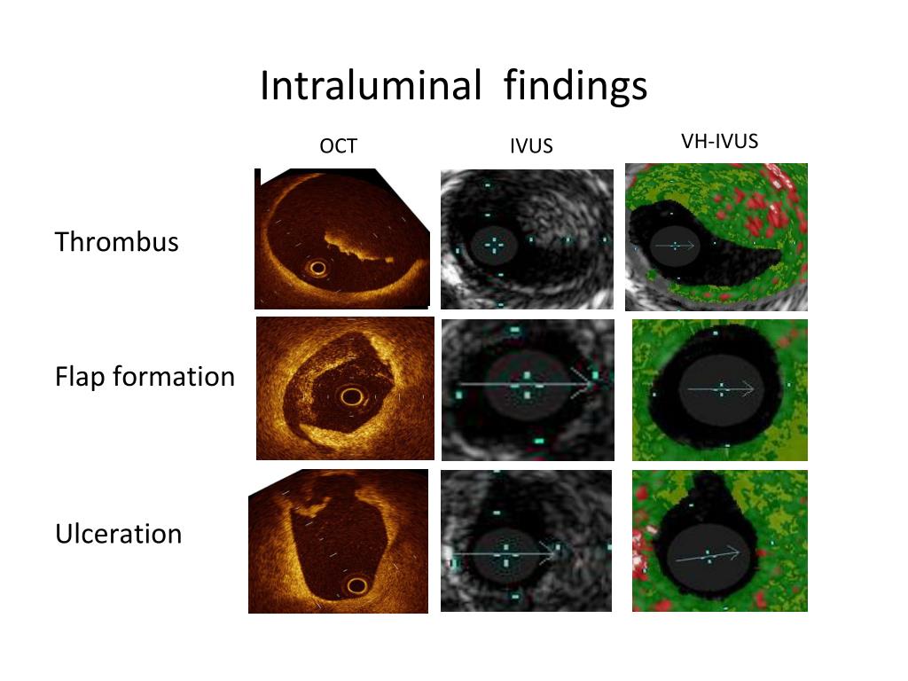 PPT - Clinical application of optical coherence tomography for carotid ...
