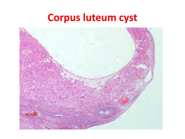 PPT - O varian cysts PowerPoint Presentation - ID:2421349