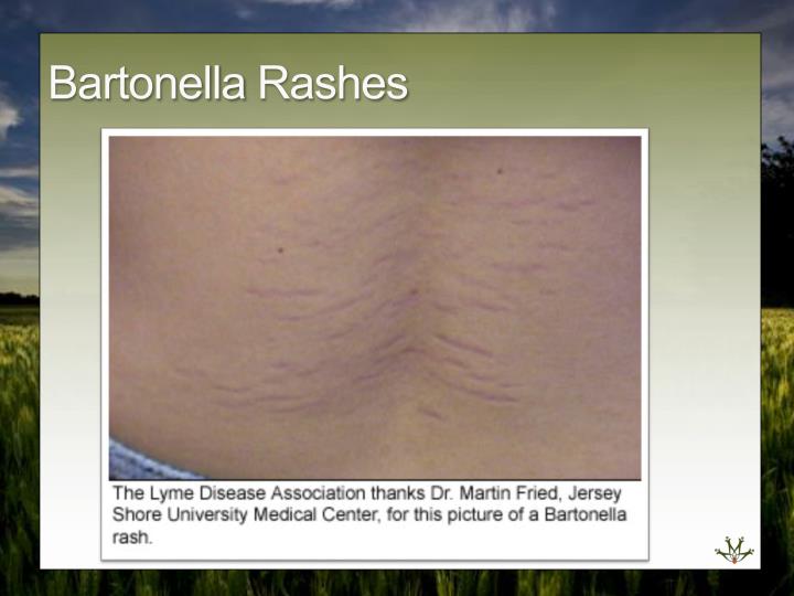 PPT - Symptoms: common and less common Lyme Disease Misdiagnosed as ...