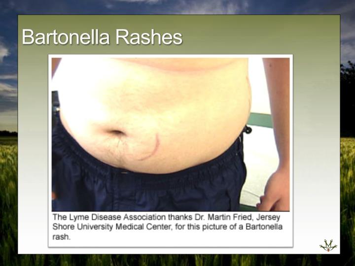PPT - Symptoms: common and less common Lyme Disease Misdiagnosed as ...