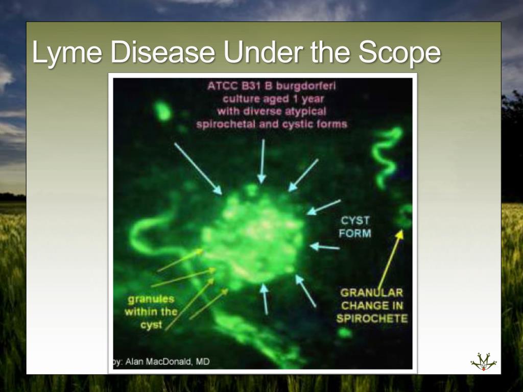 PPT - Symptoms: common and less common Lyme Disease Misdiagnosed as ...