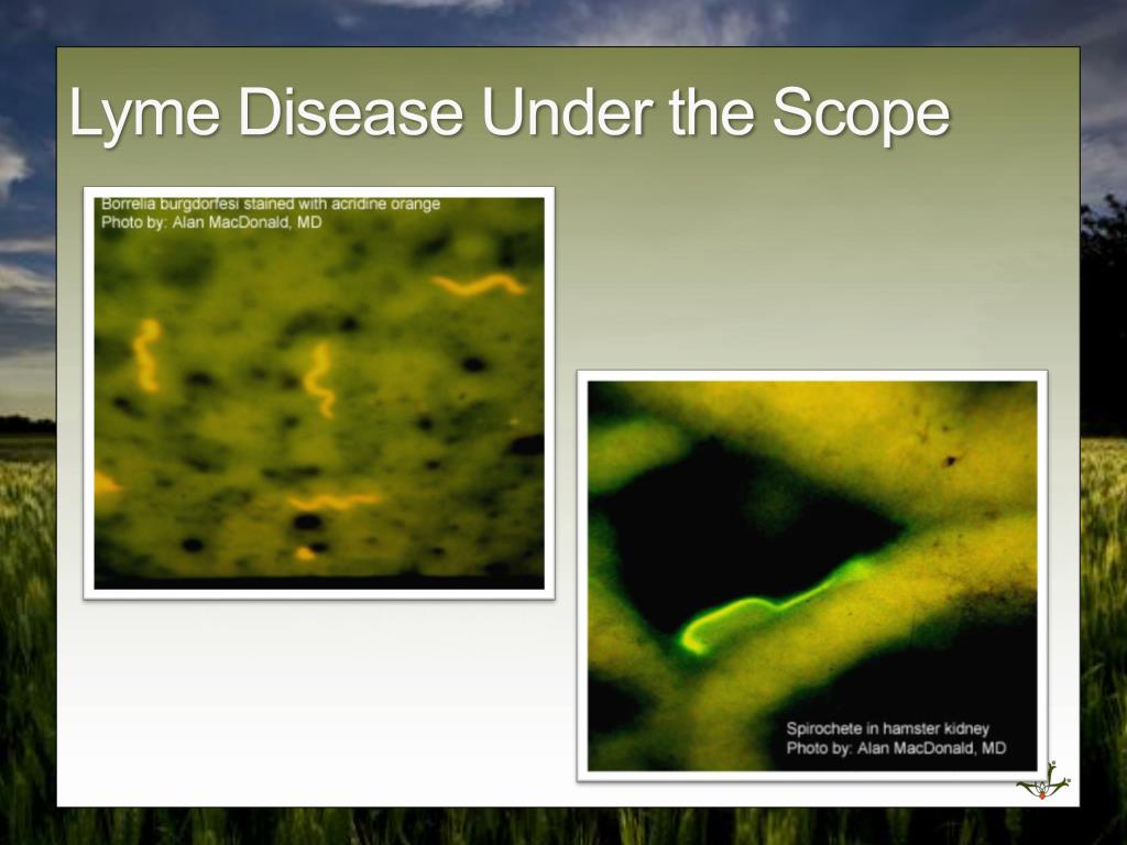 PPT - Symptoms: common and less common Lyme Disease Misdiagnosed as ...