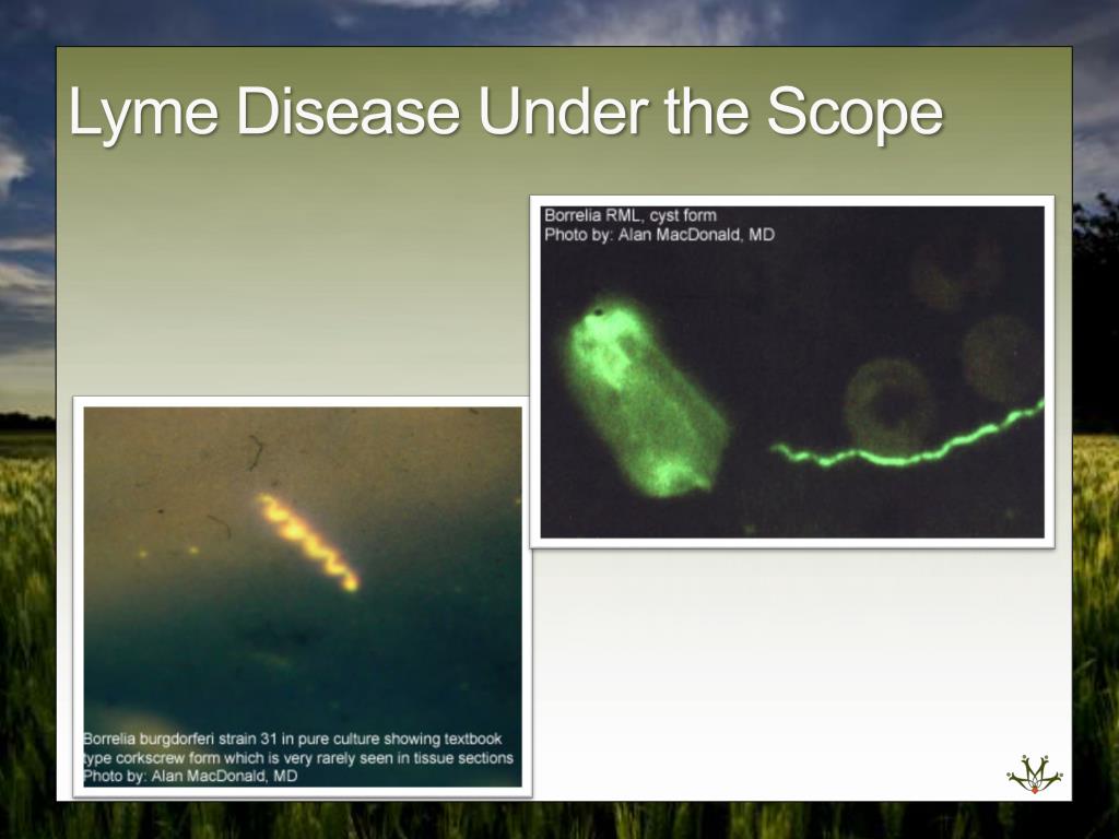 PPT - Symptoms: common and less common Lyme Disease Misdiagnosed as ...