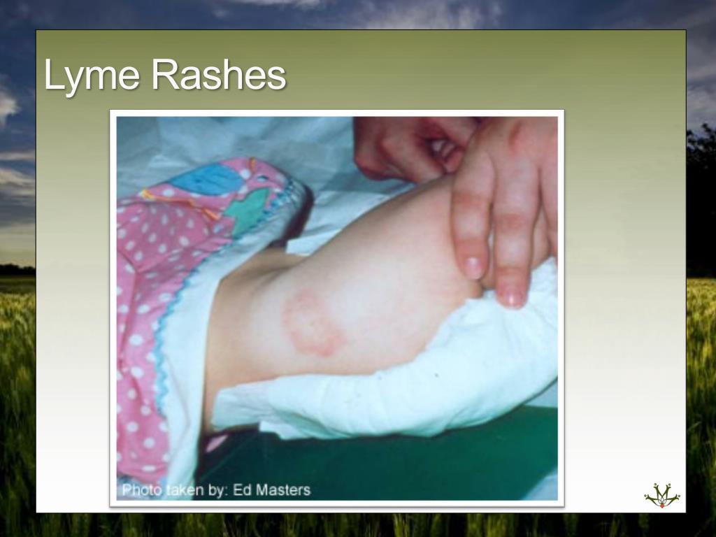 PPT - Symptoms: common and less common Lyme Disease Misdiagnosed as ...