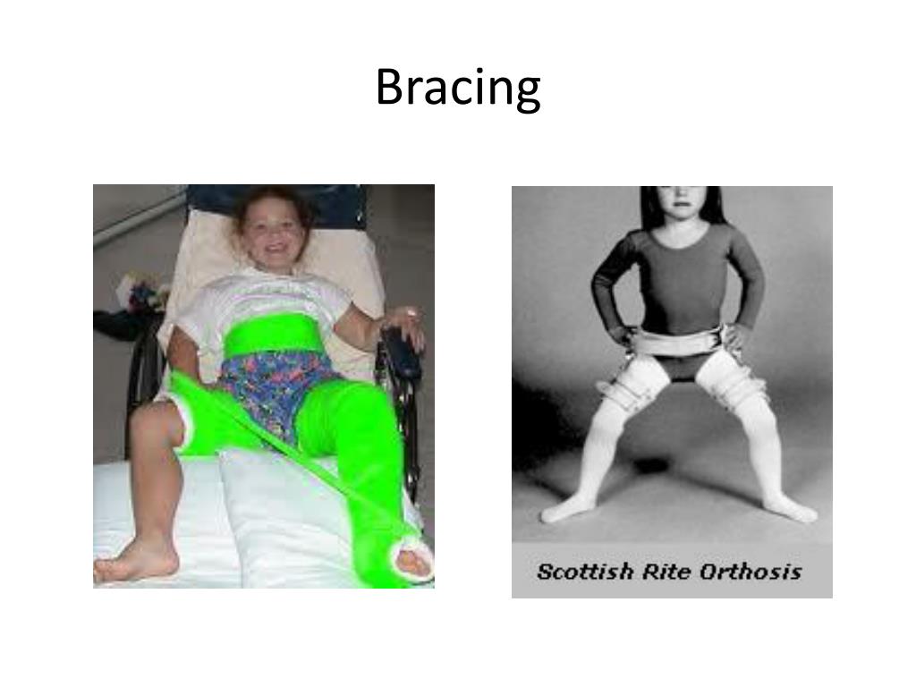 PPT - Legg- Calve – Perthes disease PowerPoint Presentation, free ...