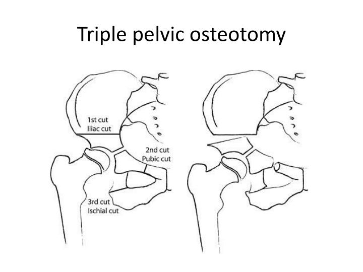 PPT - Legg- Calve – Perthes disease PowerPoint Presentation - ID:2428250
