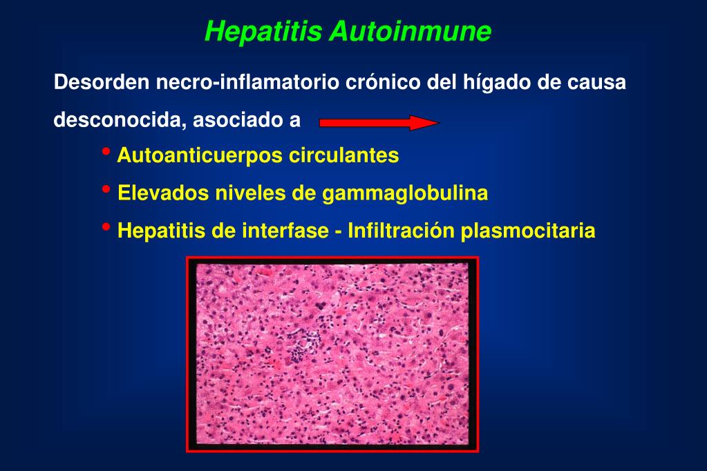 PPT - Enfermedad Hepática Autoinmune PowerPoint Presentation, free ...