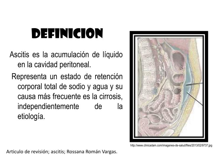 PPT - ASCITIS PowerPoint Presentation - ID:2430244