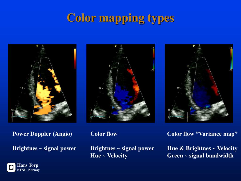 PPT - MEDT8002 Ultralyd bildediagnostikk Faglærer: Hans Torp PowerPoint ...
