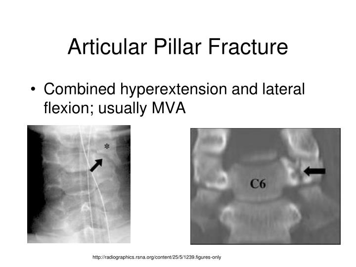 PPT - Cervical Spine Trauma PowerPoint Presentation - ID:2442688