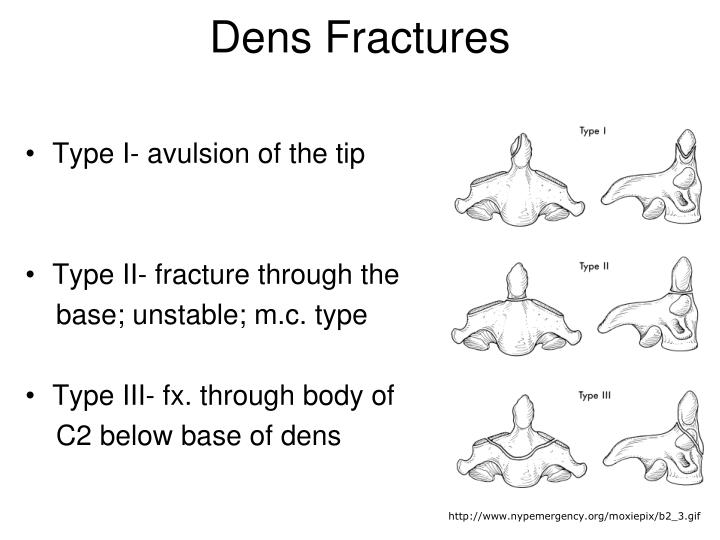 PPT - Cervical Spine Trauma PowerPoint Presentation - ID:2442688