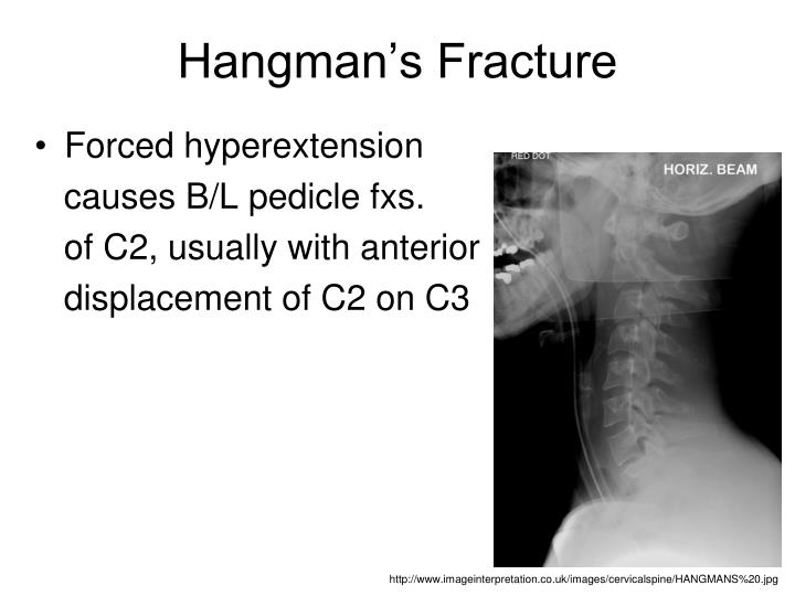 PPT - Cervical Spine Trauma PowerPoint Presentation - ID:2442688
