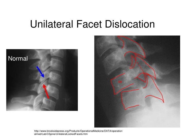 PPT - Cervical Spine Trauma PowerPoint Presentation - ID:2442688