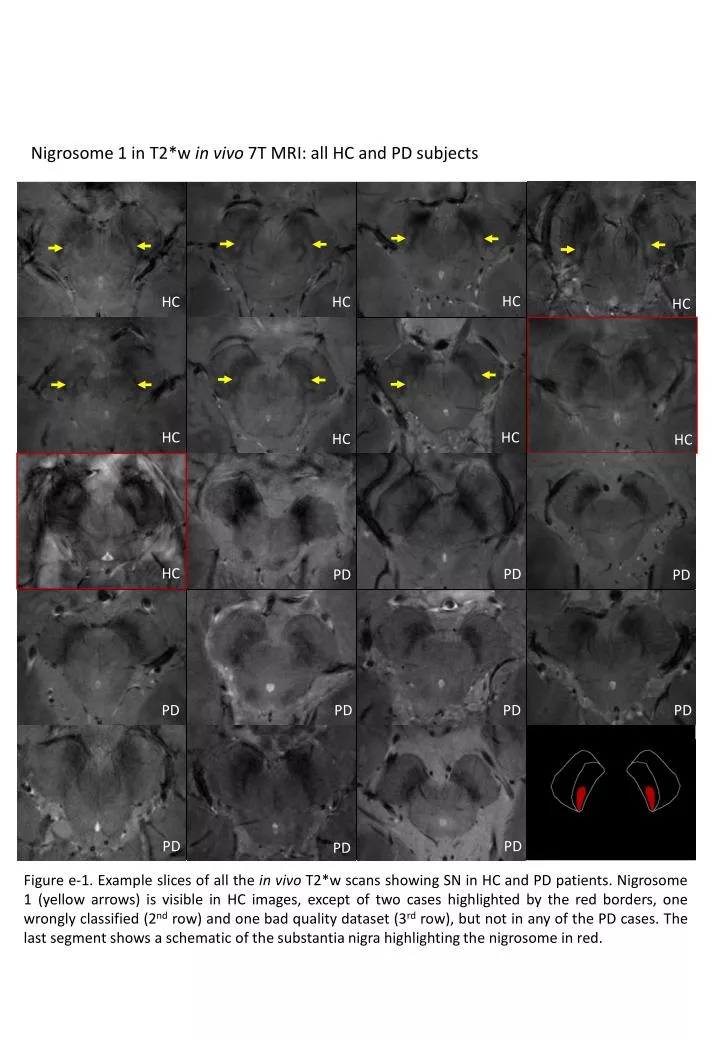 PPT - Nigrosome 1 in T2*w in vivo 7T MRI: all HC and PD subjects ...