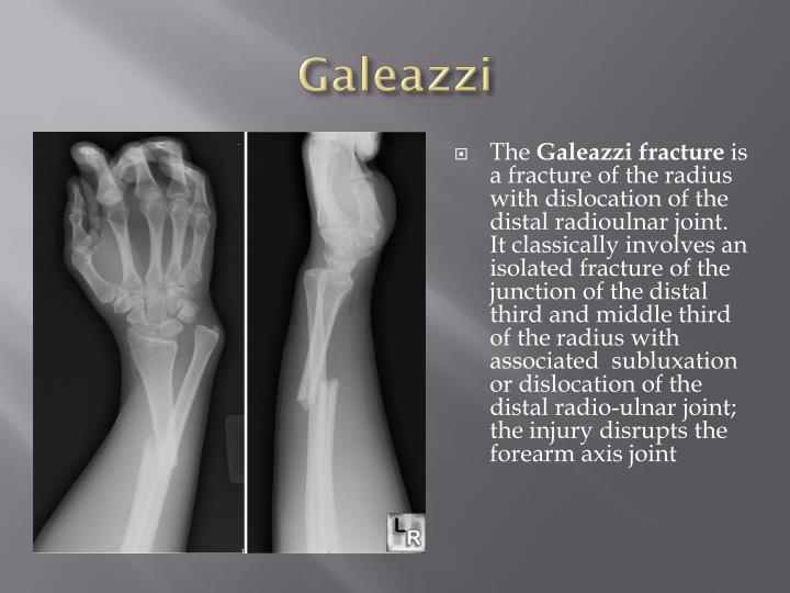 PPT - Wrist Fx PowerPoint Presentation - ID:2443937