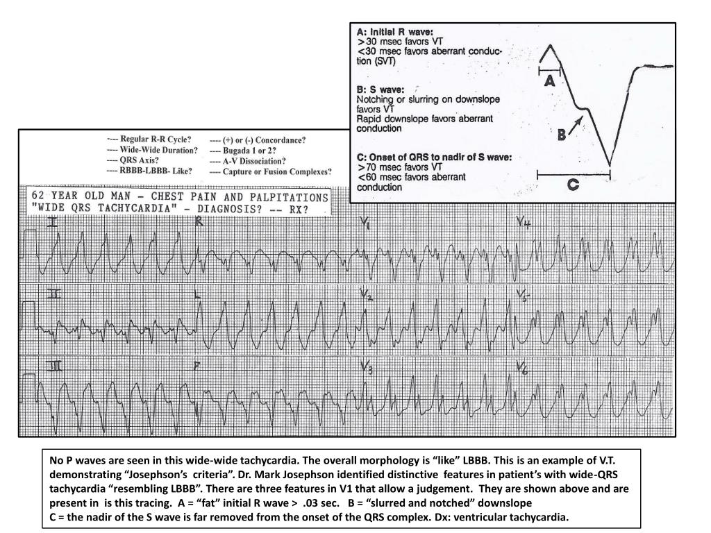 PPT - WIDE-QRS TACHYCARDIAS PowerPoint Presentation, free download - ID ...
