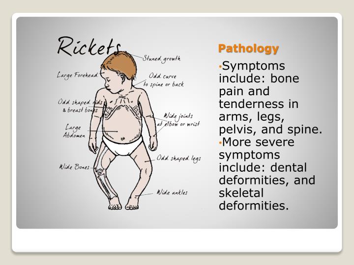 PPT - Rickets PowerPoint Presentation - ID:2451262